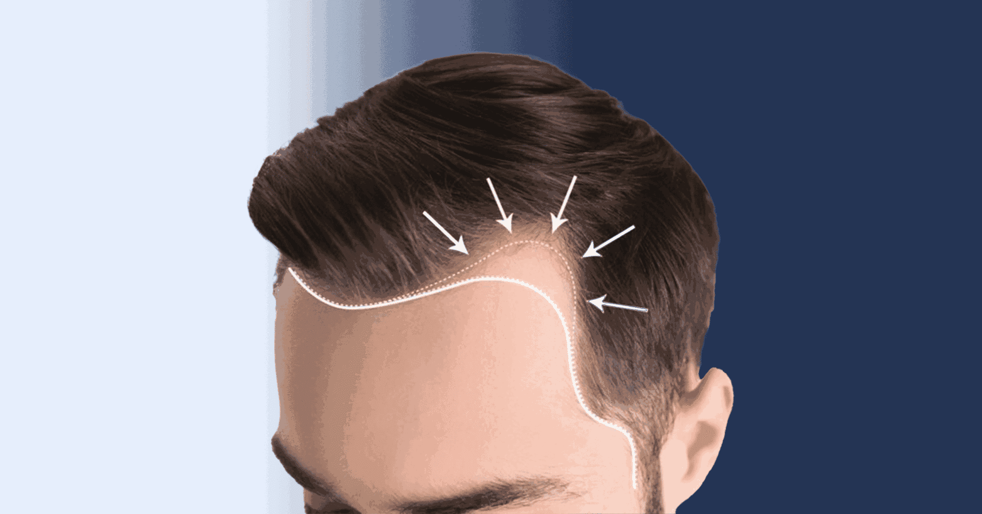 Haarlijn: Geheimen voor een natuurlijke look - Hairtec